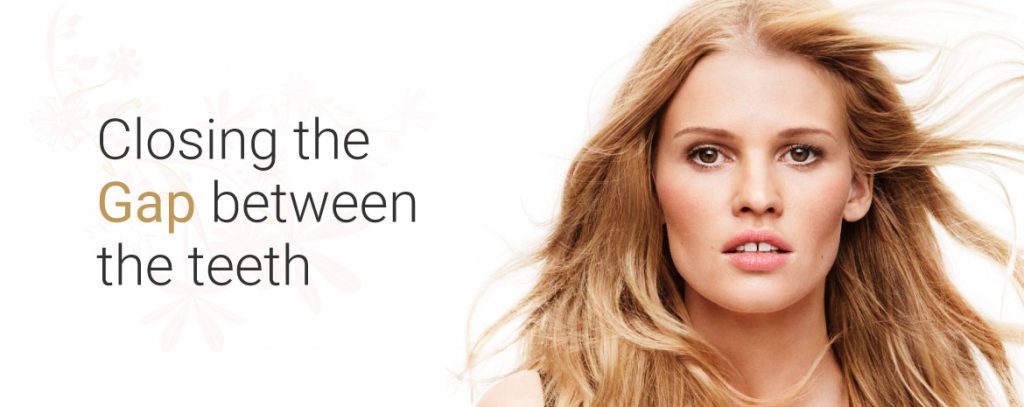 Gaps-Teeth – The Welbeck Clinic