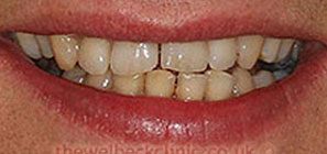 small-teeth-over – The Welbeck Clinic