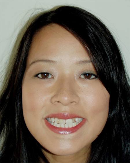 Example-Smile – The Welbeck Clinic