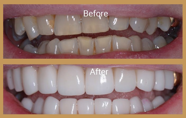 Crowded-Uneven-Teeth-v6a – The Welbeck Clinic
