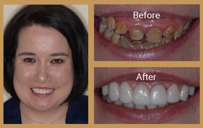 Small-Teeth-v1a – The Welbeck Clinic