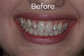 Porcelain-Veneers-3a – The Welbeck Clinic