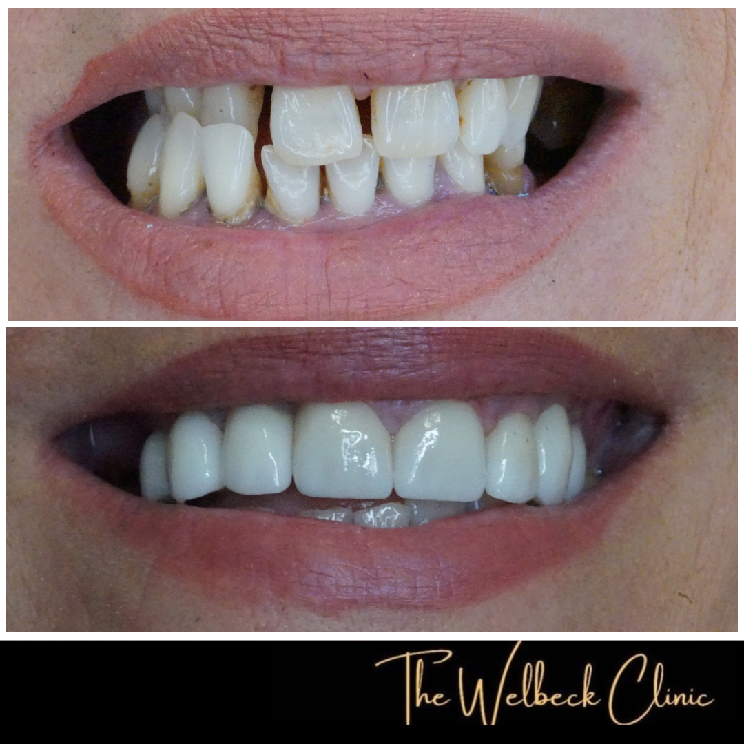 Porcelain Veneers: A Guide to Natural Smile Makeovers | The Welbeck Clinic
